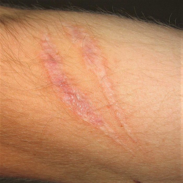 What Does Scar Mean At Albert Dickey Blog What Does Scar Mean At Albert Dickey Blog